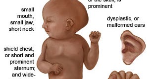 TAMBOON STORY : Trisomy 18 (Edward Syndromes)